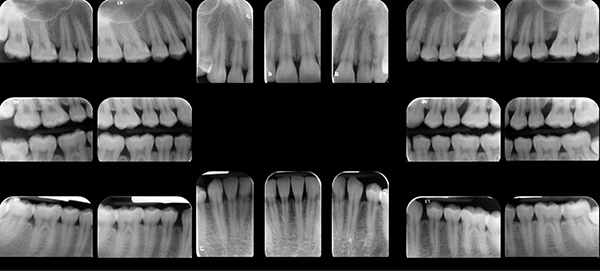 Familial Presentation of Ankyloglossia and Localized Periodontitis ...
