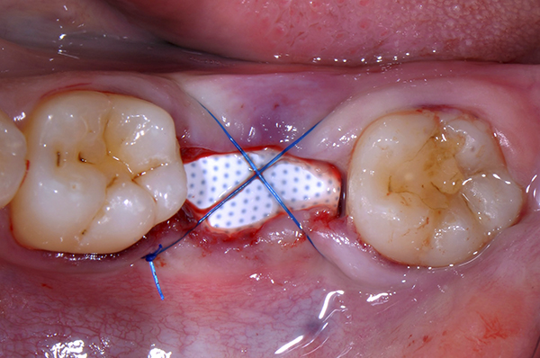 Soft Tissue Grafting Techniques Associated With Immediate Implant Placement | Compendium