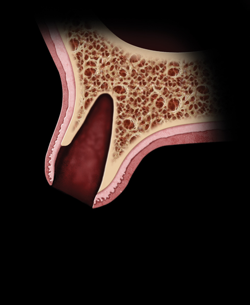Subclassification and Clinical Management of Extraction Sockets with ...
