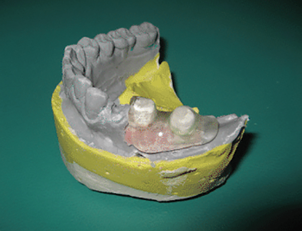 Improving Free Gingival Graft Success Around Implants Using a Completed ...