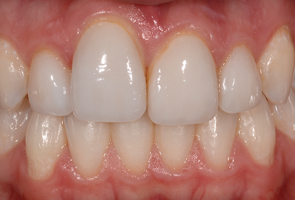 Clinical Management of Type 3 Recession Defects With Immediate Implant ...