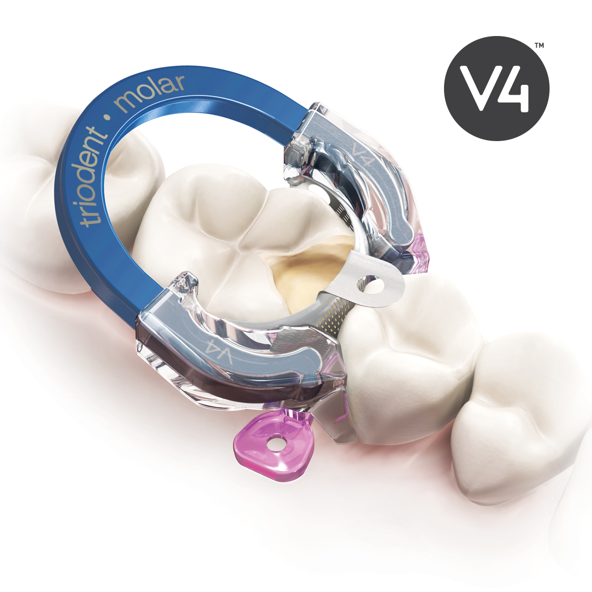 Triodent V4 Matrix System Eases Bulk-Fill Resin Placement, Improves ...