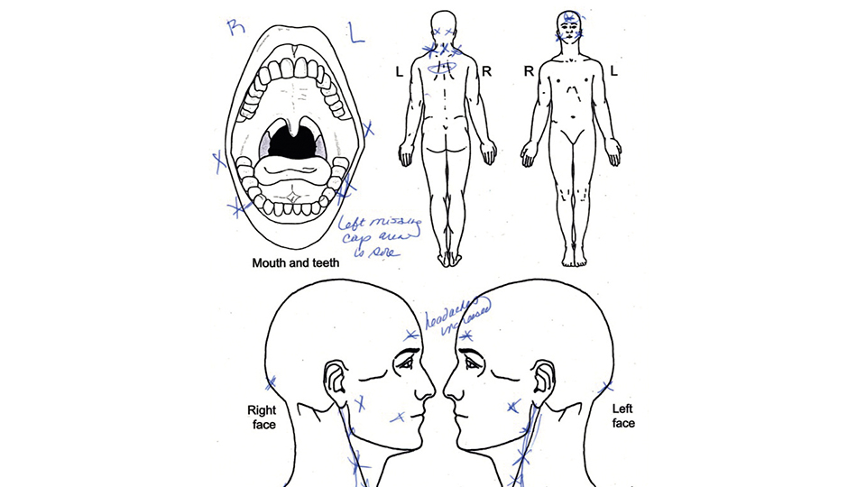 Use of Trigger Point Injections in the Management of Myofascial Pain in ...