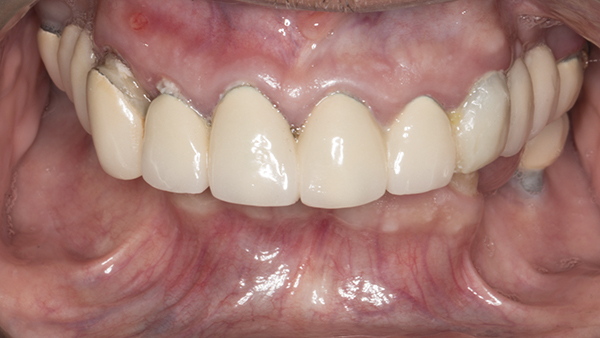 When Guided Surgery Fails: A Routine to Recover the Implant Original ...