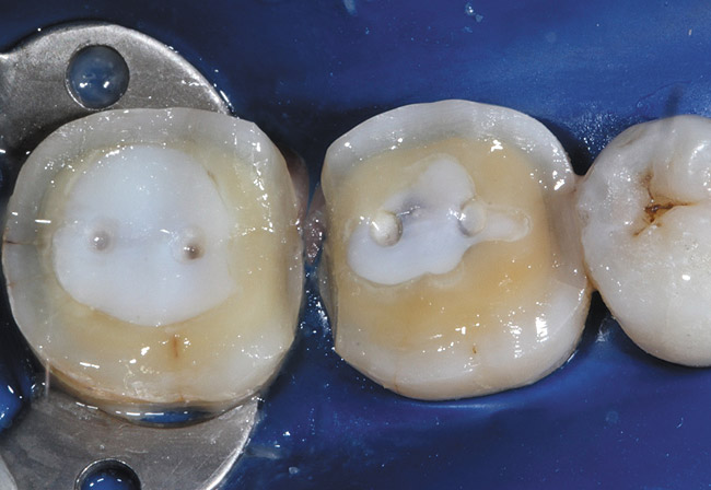 Reverse Spot Bonding: A Novel Technique for Provisionalization with ...