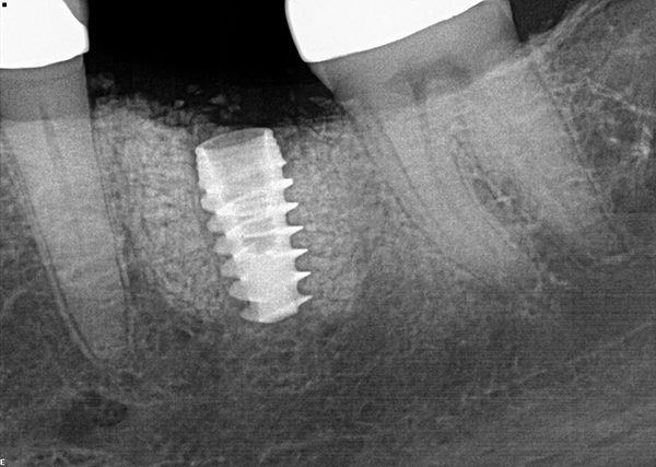 Current State of Bone Replacement Grafting Materials for Dental ...