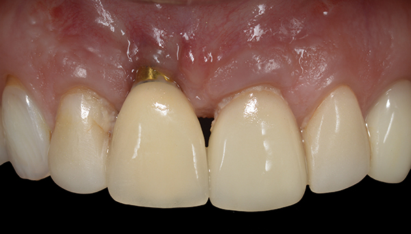 Tapered Versus Inverted Body-Shift Implants Placed Into Anterior Post ...