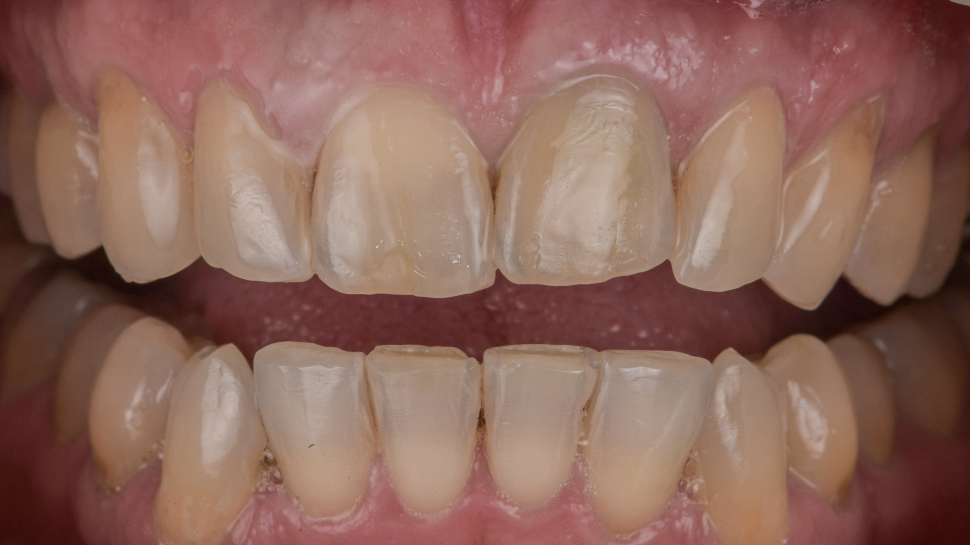 Fabrication of a Dual-Purpose Implant Surgical Guide | Compendium