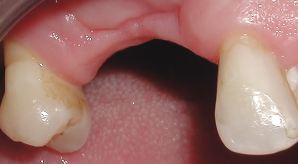 Restoring a Long-Edentulous Maxillary Ridge Segment with Adjacent ...