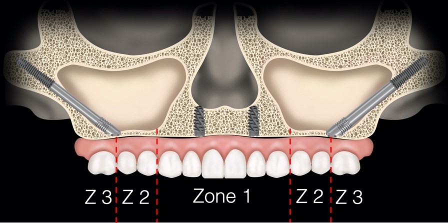 Zygomatic Implant Redesigned: Rationale and Biomechanical Principles ...