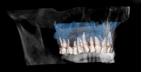 Guided Full-Arch Immediate-Function Treatment Modality for the ...