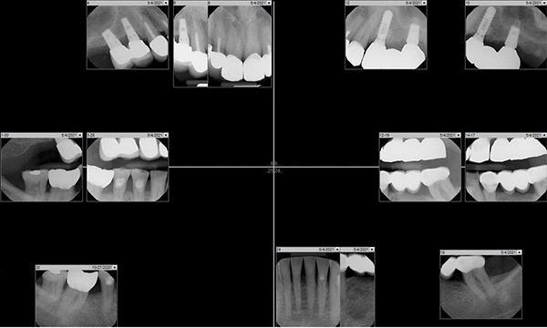 Hemisection in the Age of Dental Implants: A Case Report | Compendium