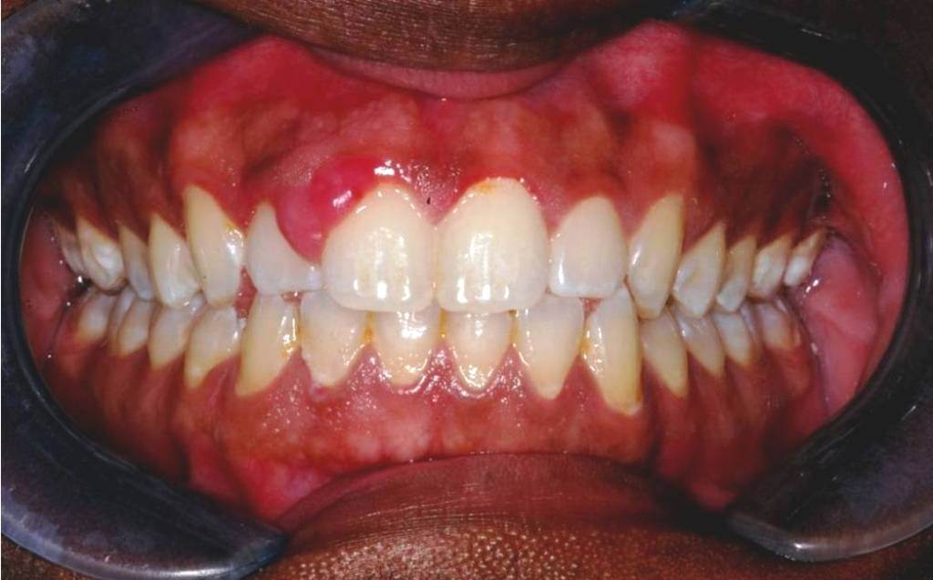 Peripheral Odontogenic Fibroma Radiograph Maxillary Occlusal