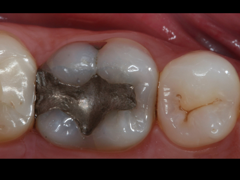 Lithium Disilicate - The Restorative Material of Multiple Options ...