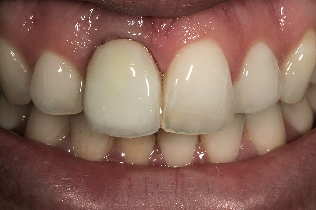 Custom Shade Matching: Fine-Tuning and Patient Communication Lead to ...