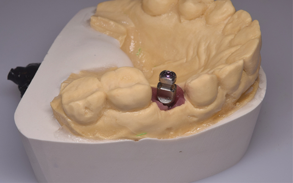 A Novel Design of a Pick-up–Type Impression Coping | Compendium