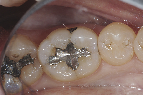 Mod Amalgam Restoration
