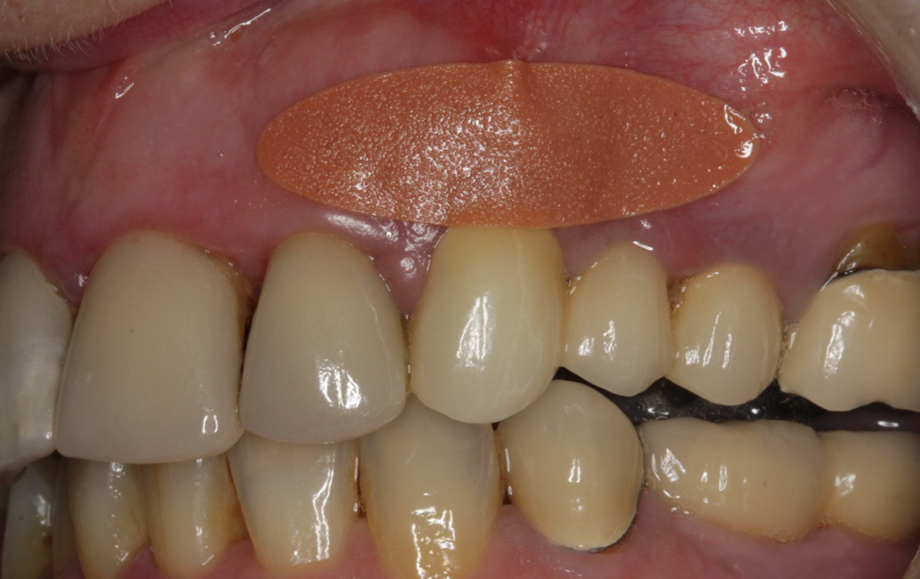 Adjunctive Treatment of Periodontal Disease with Self-Adhesive Hydrogel ...