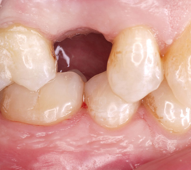 A Retrospective Analysis of 12 Immediate-Implant Restorations in the ...