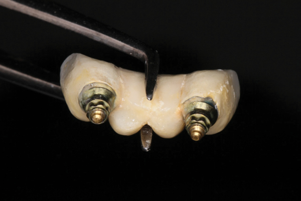Retrieval of a Defective Cement-Retained Implant Prosthesis | Compendium