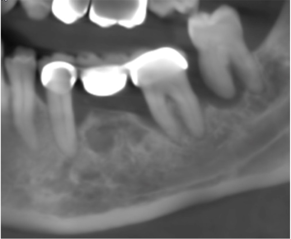 Improving the Prognosis of Periodontally Involved Teeth at the Time of ...