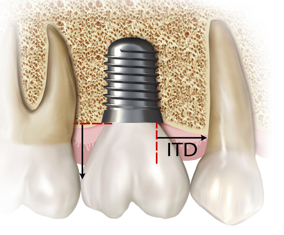 Influence of Implant–Tooth Proximity on Incidence of Caries in Teeth ...