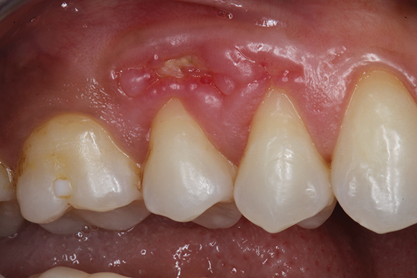 Treatment of a Gingival Injury From a Cosmetic Laser Burn: A Case ...