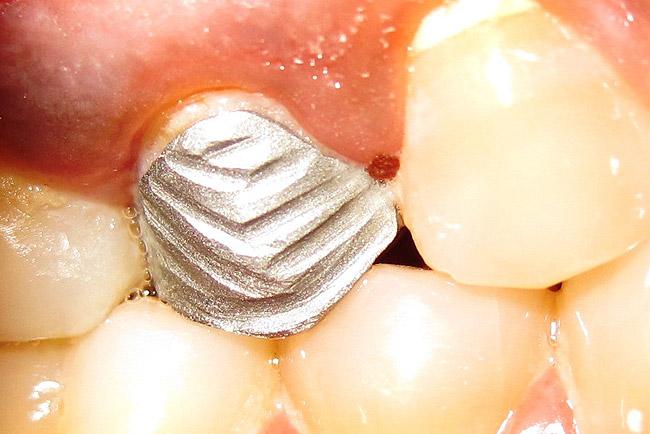 Conservative Approach for Esthetic Repair of Fractured Ceramic Facing ...