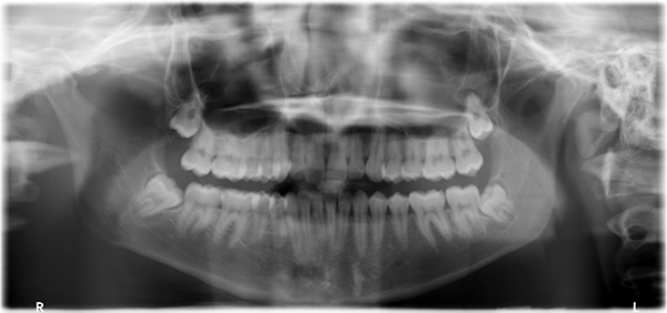 Coronectomy: An Alternative to Complicated Full-Bony Impacted Tooth ...