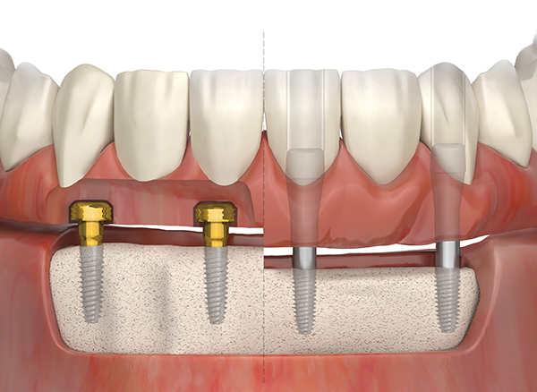 Simplicity Is the Key to Zest Dental’s New LOCATOR FIXED™ System ...