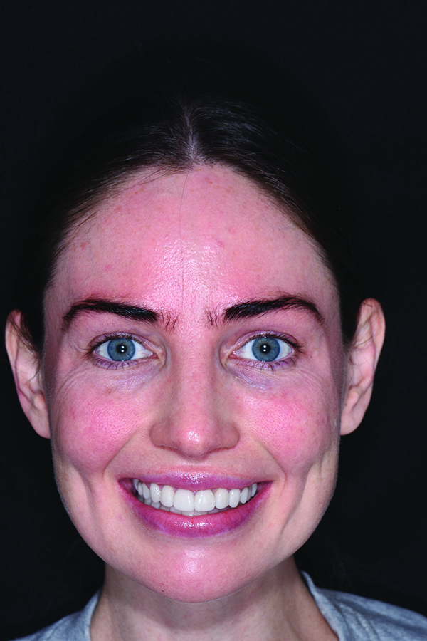 A Systematic Method for a Full-Mouth Rehabilitation of a Dentition With ...