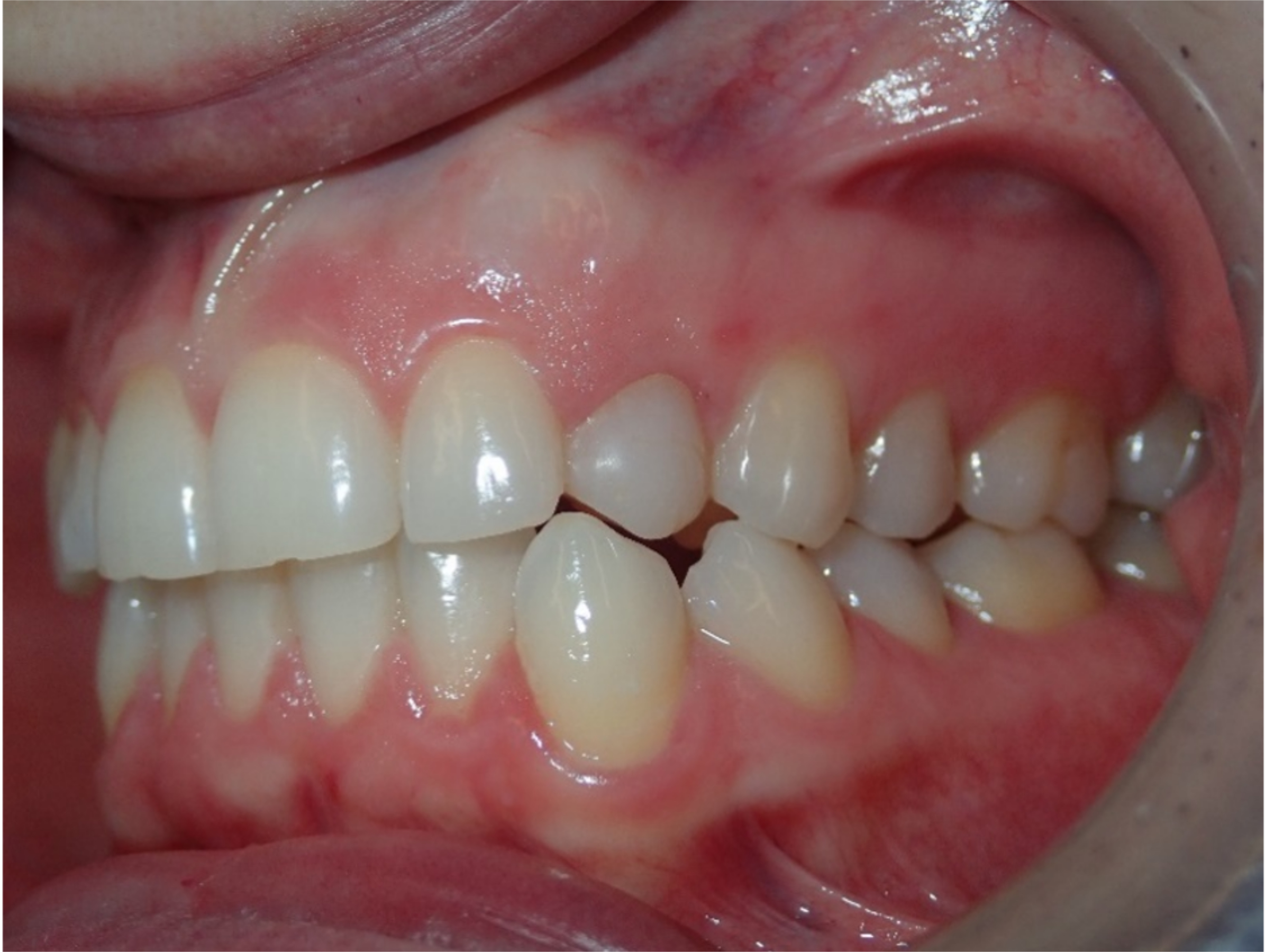 Implant Placement When an Impacted Tooth and Supernumerary Teeth Are ...