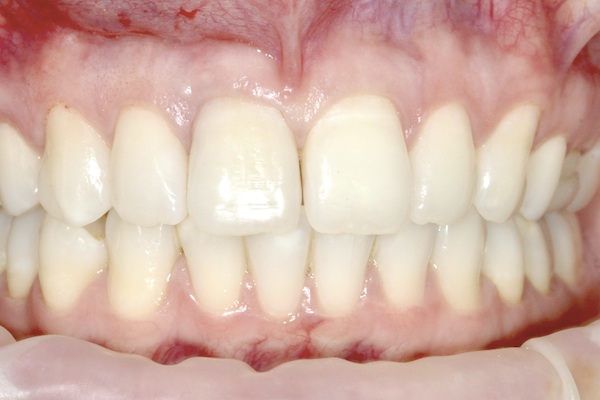 Immediate Implant Placement and Provisionalization Using the Patient’s ...