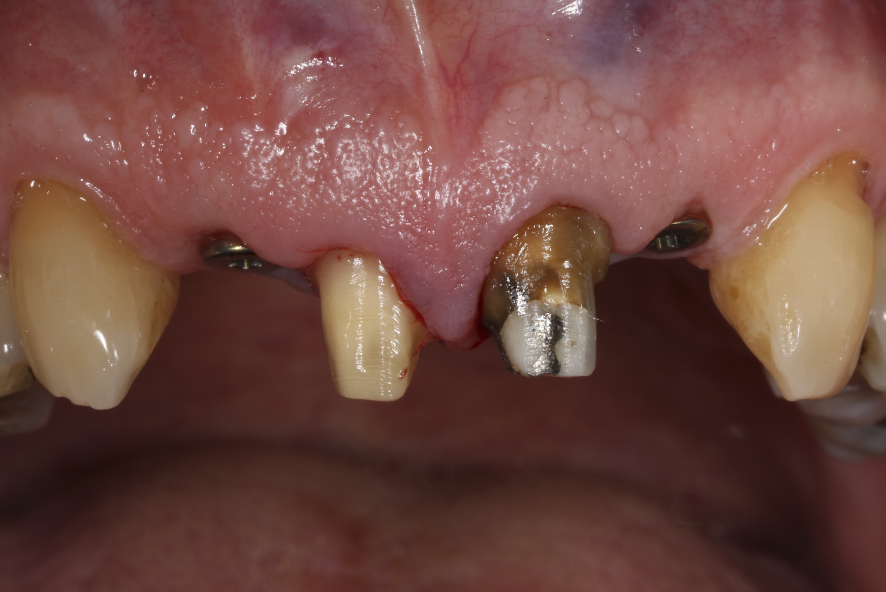 Digital Workflow With a Triple Scanning Technique for Implant ...